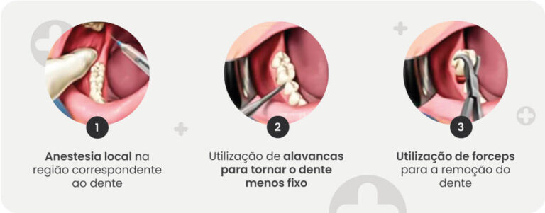 Exodontia de dente: conheça os 5 passos da extração de dente