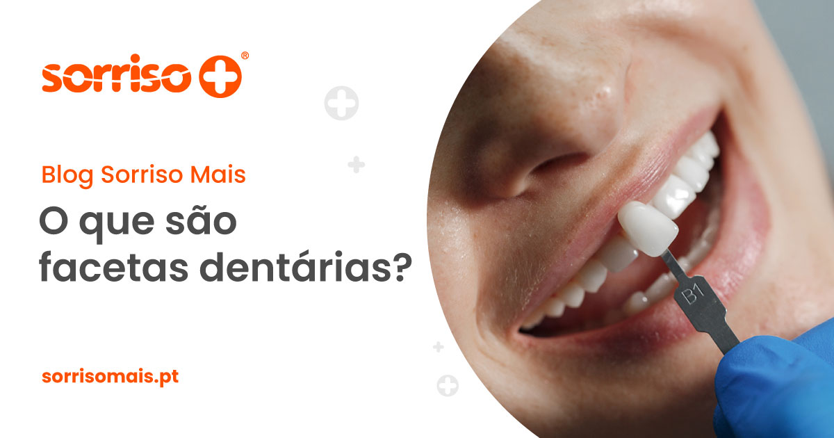 O que são facetas dentárias? - Sorriso Mais