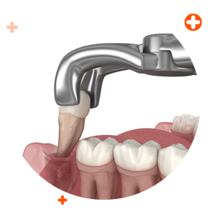 Exodontia - Plano Dental Sorriso Mais